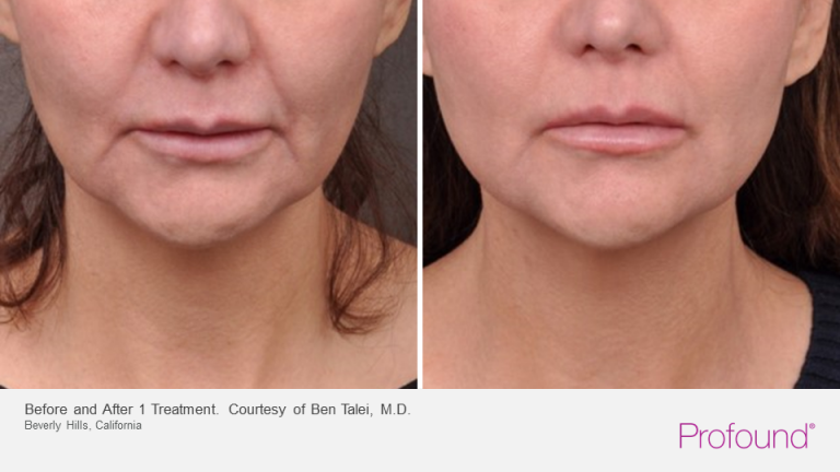 What You Should Know About Profound RF | Columbia Skin Clinic