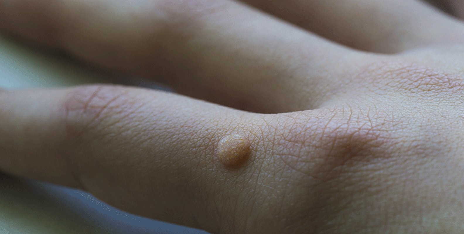 Ask a Dermatologist: How to Get Rid of Warts | Columbia, S.C.