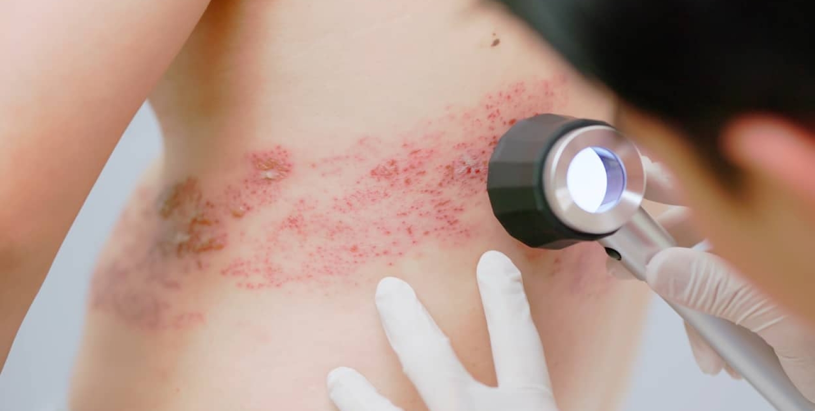 What Causes Shingles and How to Treat It | Dermatology