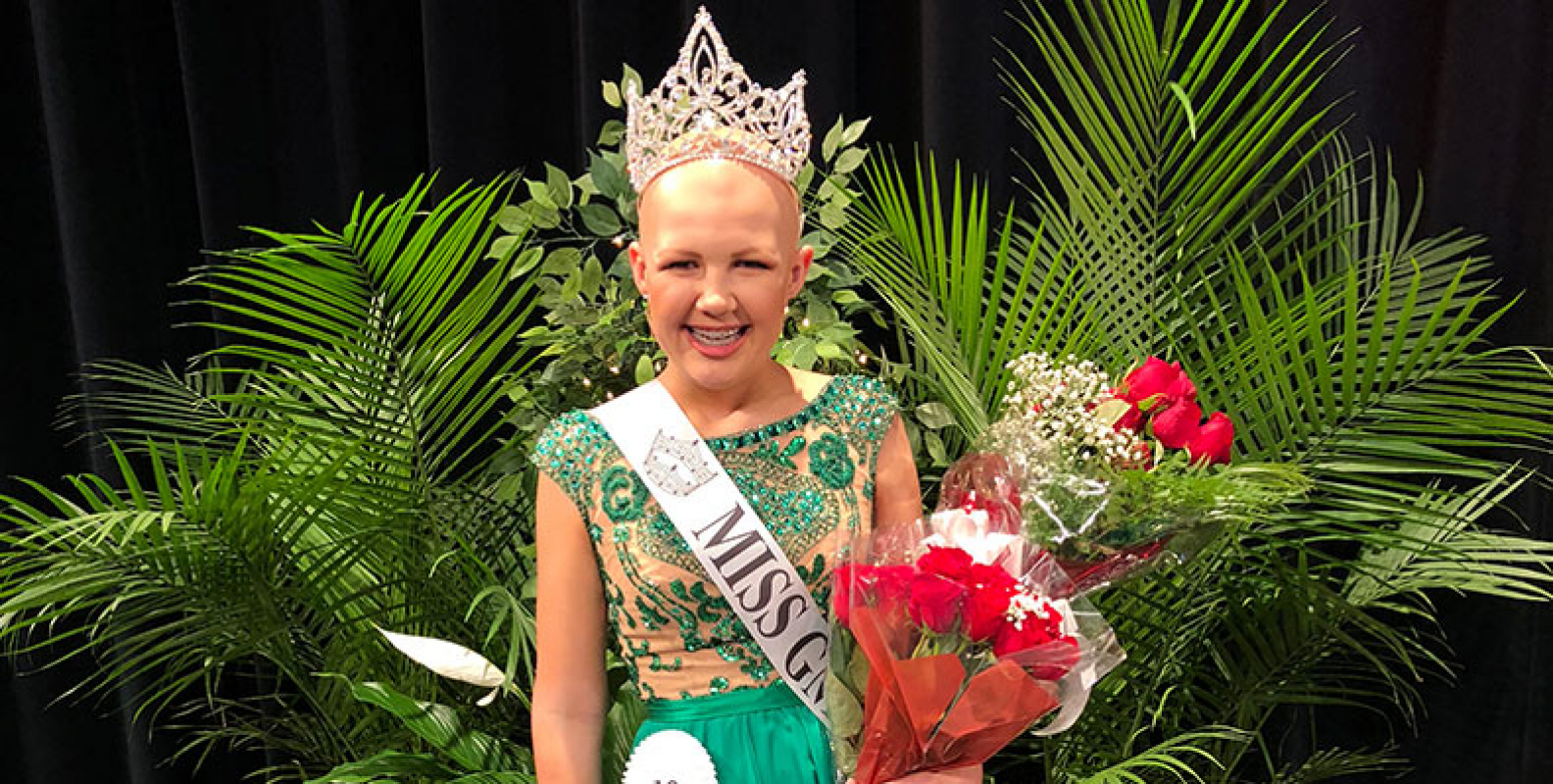 Local Teenage Pageant Queen - Bald is Beautiful - Columbia Skin Clinic