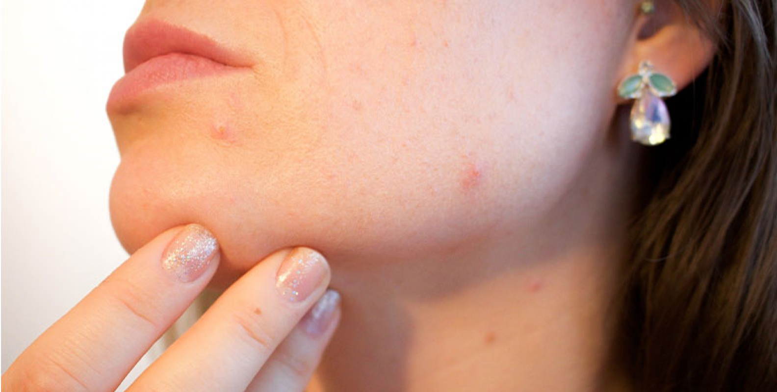 Hormonal Acne: What it is and Why it Happens - Columbia Skin Clinic