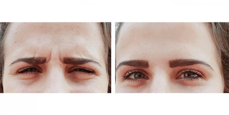 How to Make Botox Last Longer - Columbia Skin Clinic