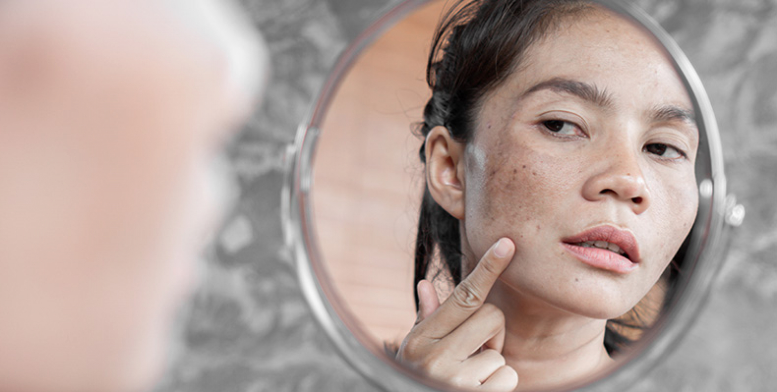 Columbia Skin Clinic Explains Hyperpigmentation vs. Melasma