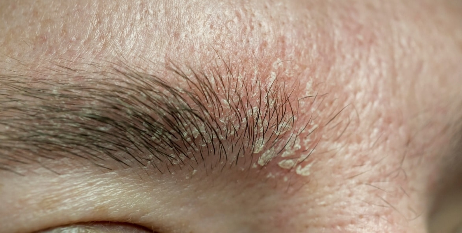 Your Dry, Flaky Skin Could Be Seborrheic Dermatitis