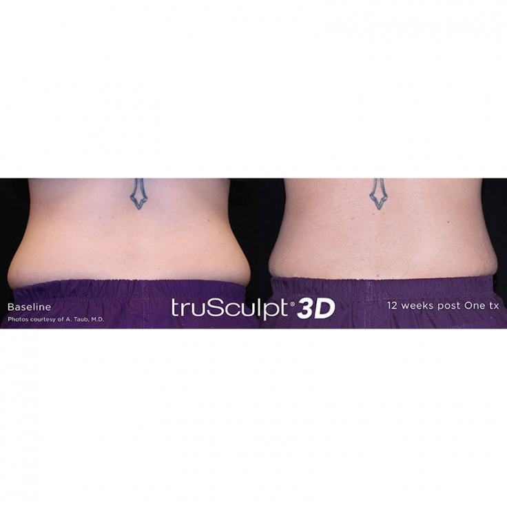 Body Contouring Cosmetic Dermatolgoy Columbia Skin Clinic