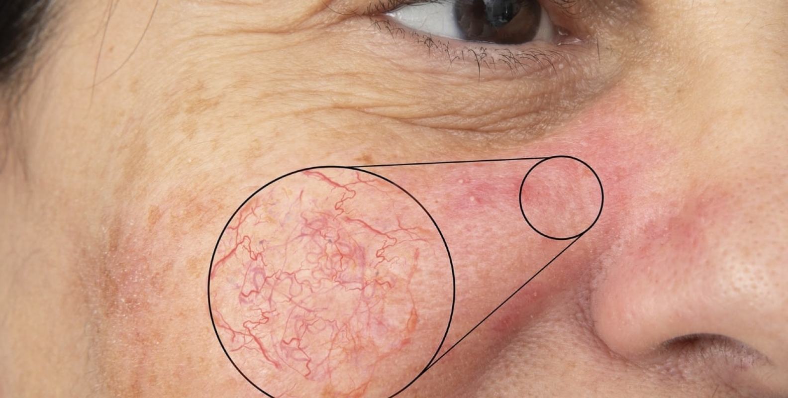 Broken Capillaries – Cause and Treatment | Ask a Dermatologist